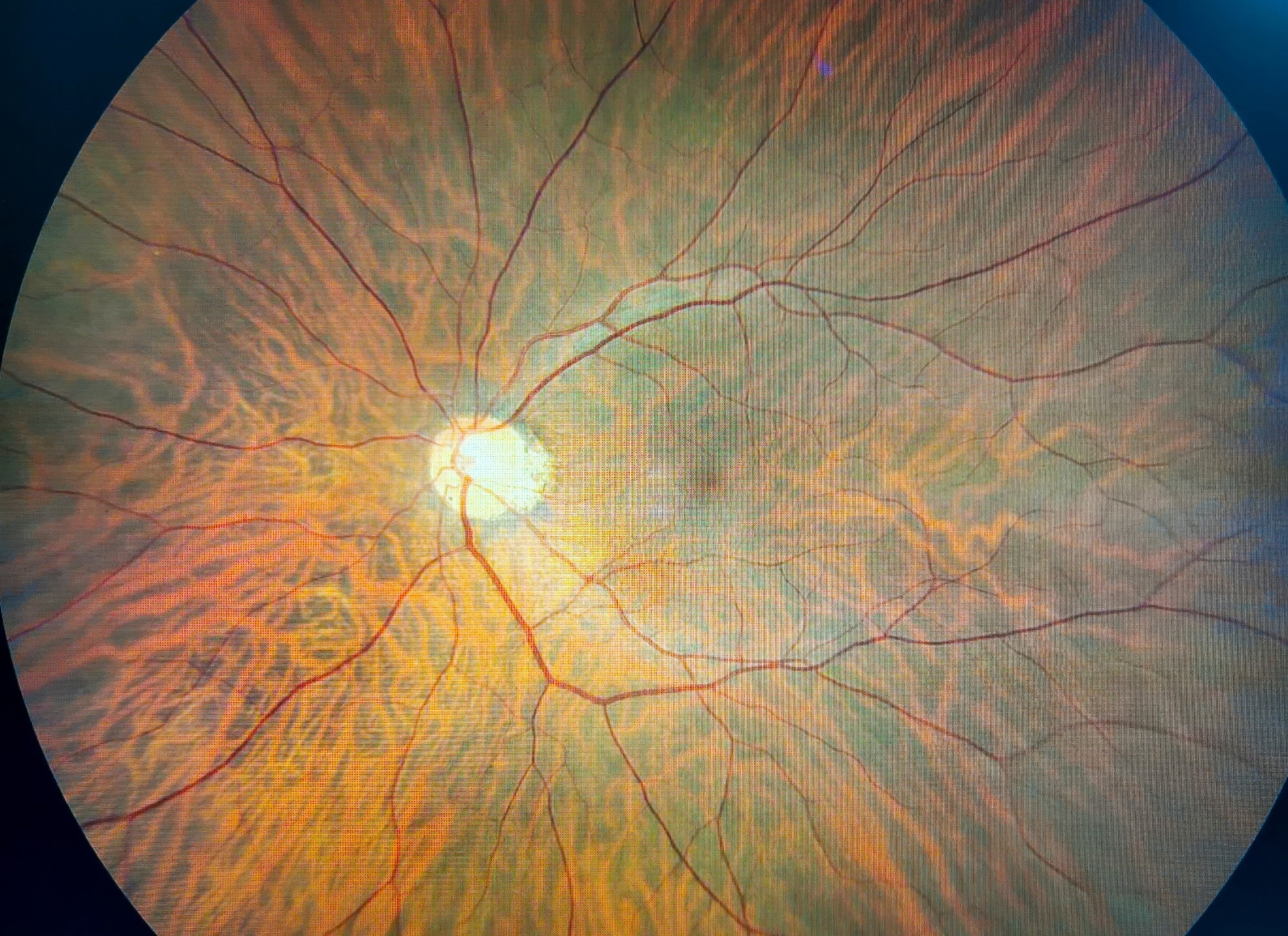 Disease-Induced Retina Damage